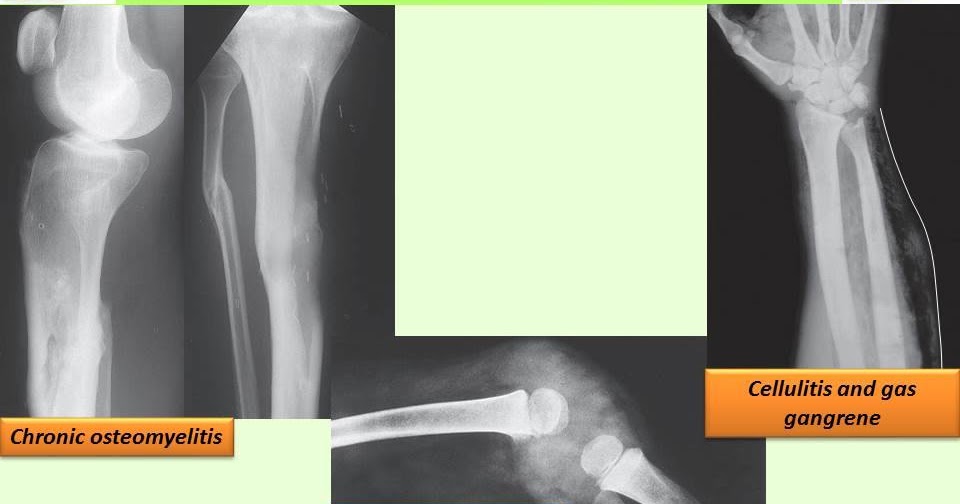 Easy Radiology: Bone infection
