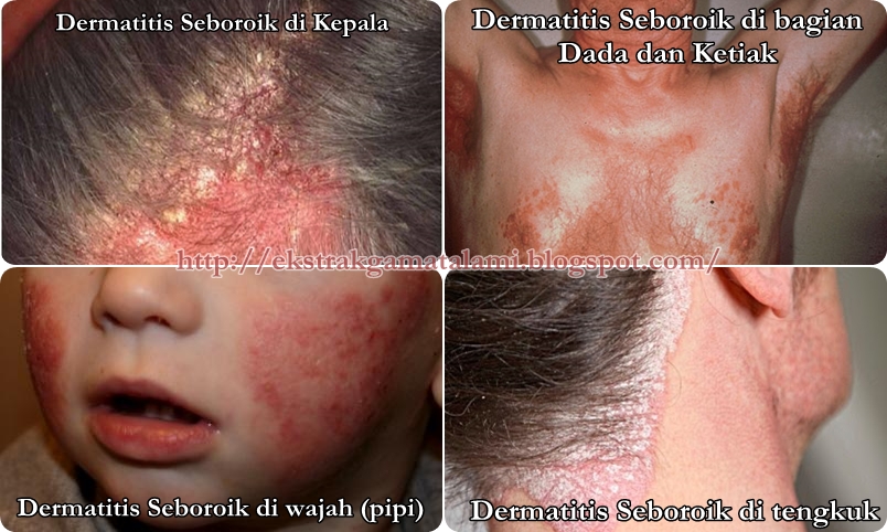 Cara Mengatasi Dermatitis Seboroik ~ Ekstrak Gamat