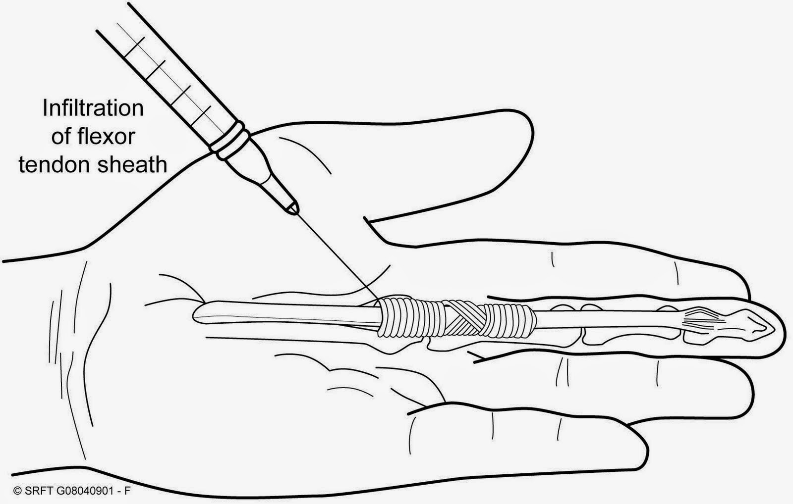 Kinebioactiva: Dedo en gatillo o tenosinovitis estenosante