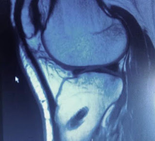 PCL Reconstruction-MRI - Radiology Imaging