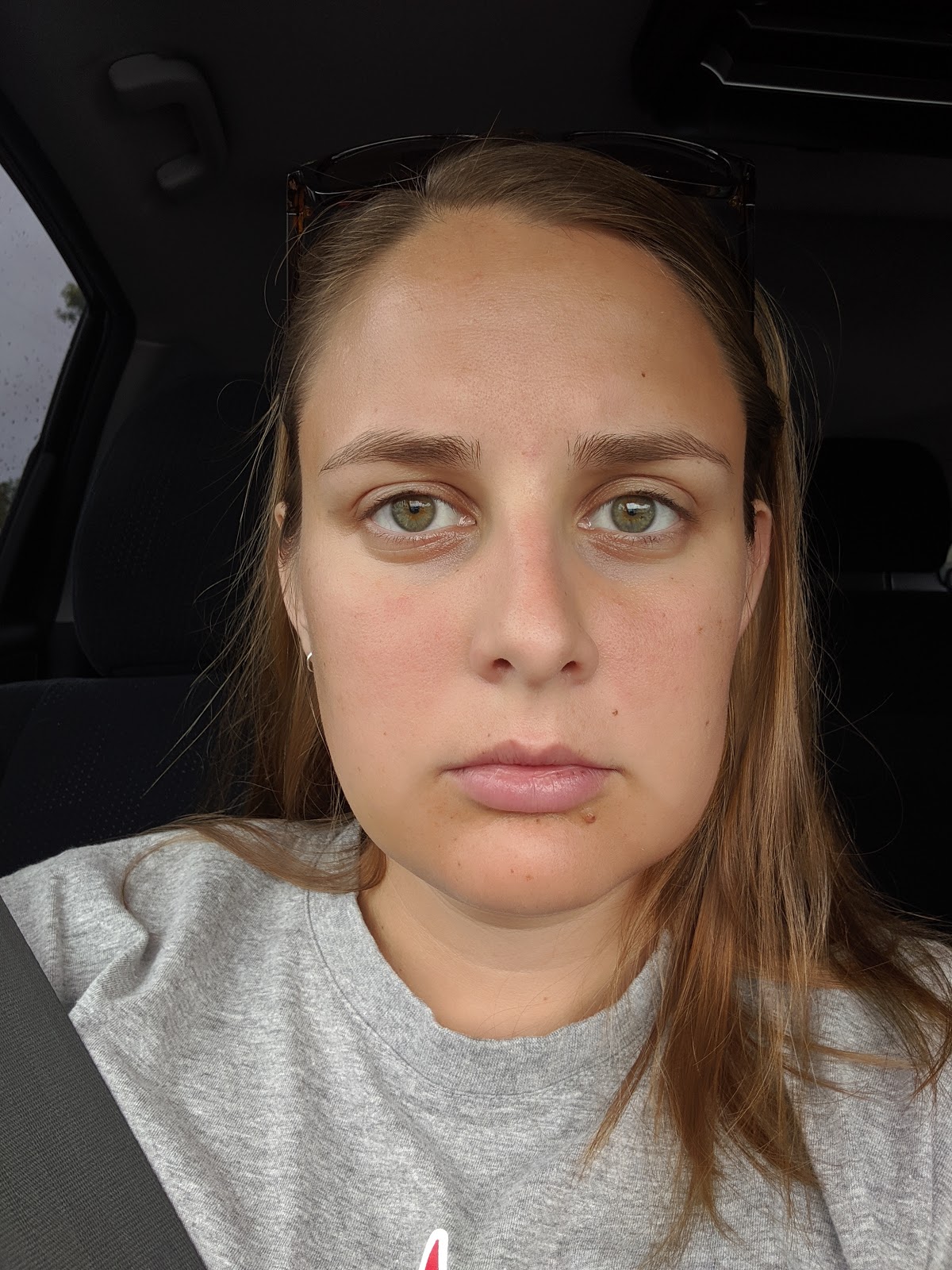 Wisdom Tooth Extraction Swelling