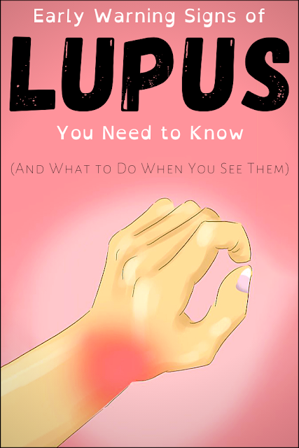 Early Warning Signs of Lupus You Need to Know (And What to Do When You ...