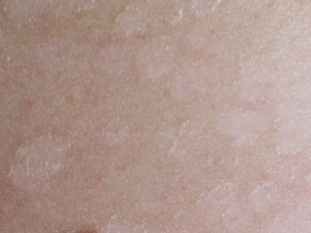 Petua Merawat Penyakit Panau