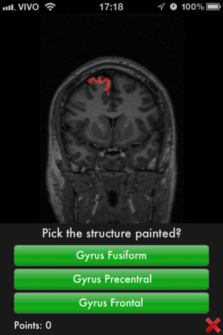 iSurf Brainview: Repaso de neuroanatomía a través de RM - probando