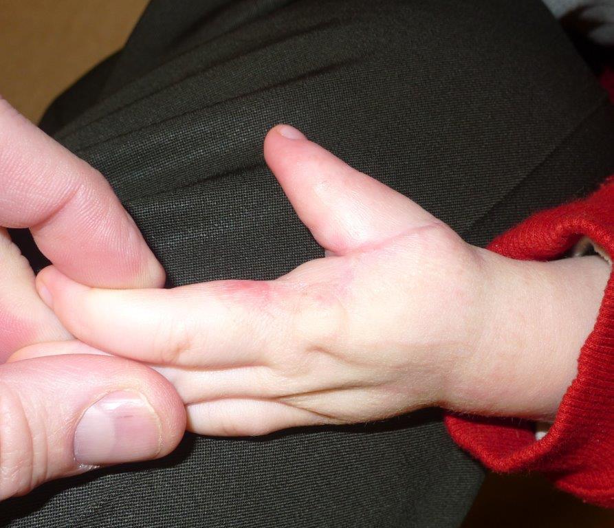 Pollicization Long Term | Congenital Hand and Arm Differences ...