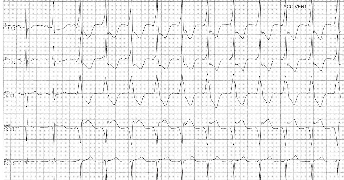 Float Nurse: Accelerated Idioventricular rhythm