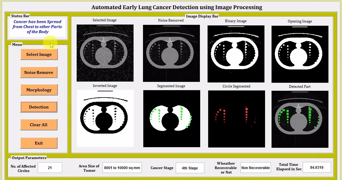 Automated Lung Cancer Detection In Medical Imaging Using Image Processing Matlab Project With