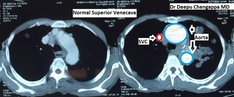 Chest Medicine Made Easy-Dr Deepu: Image Archives SVC obstruction- CT ...