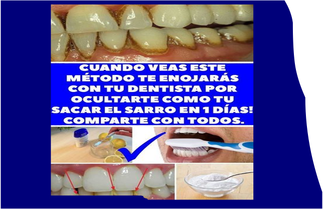 Tipos de Sarro Dental