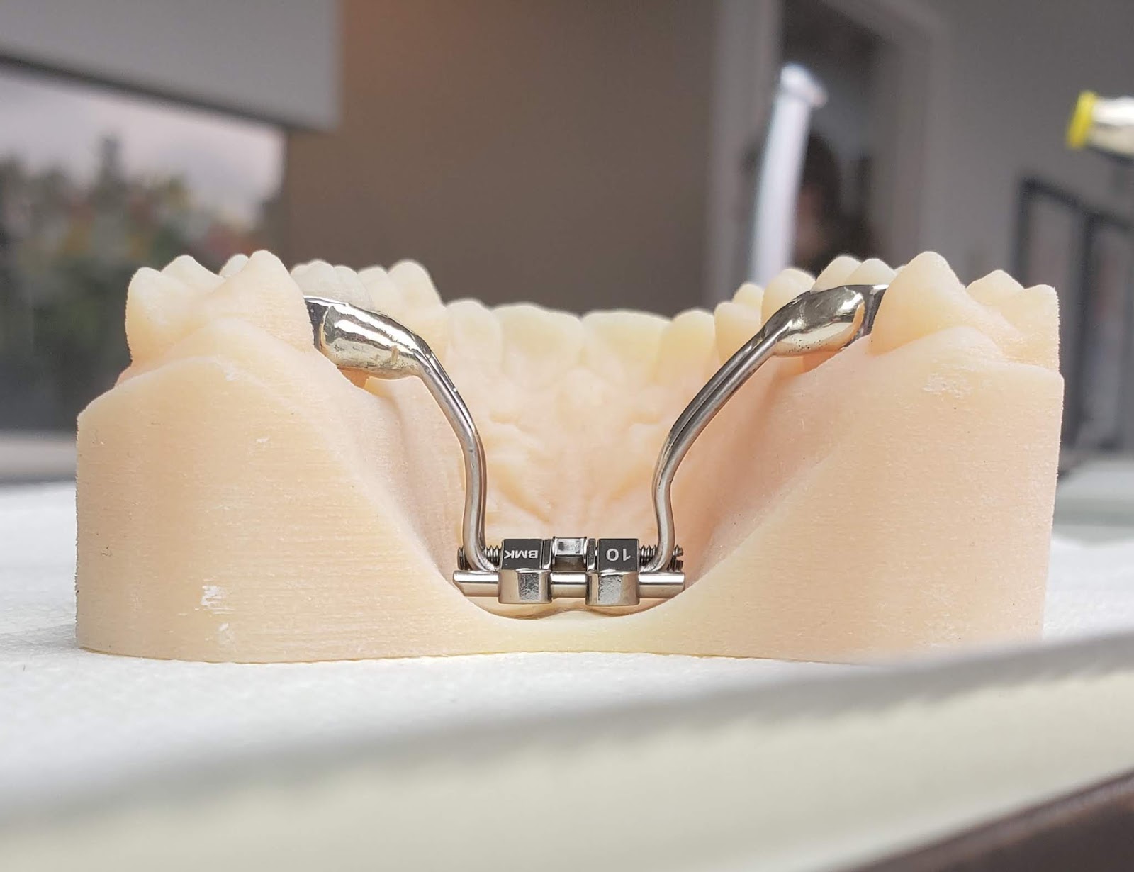 My experience with the MSE (maxillary skeletal expander): July 2019