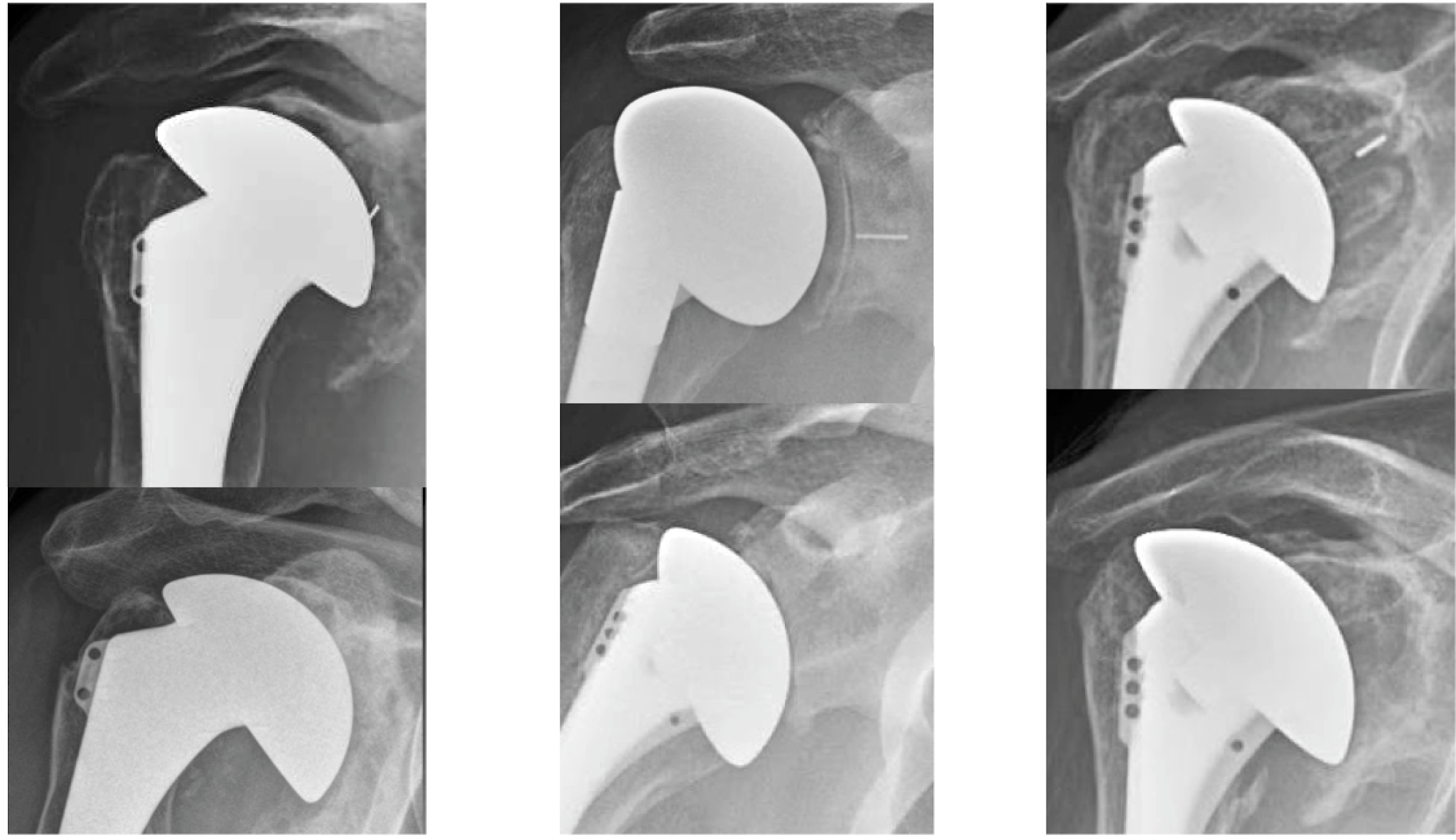 Shoulder Arthritis / Rotator Cuff Tears: causes of shoulder pain ...