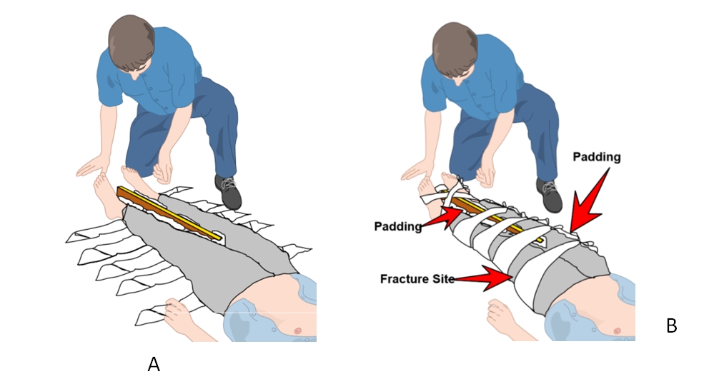 Orthopaedi Knowledges: MANAGEMENT OF LONG BONE FRACTURES