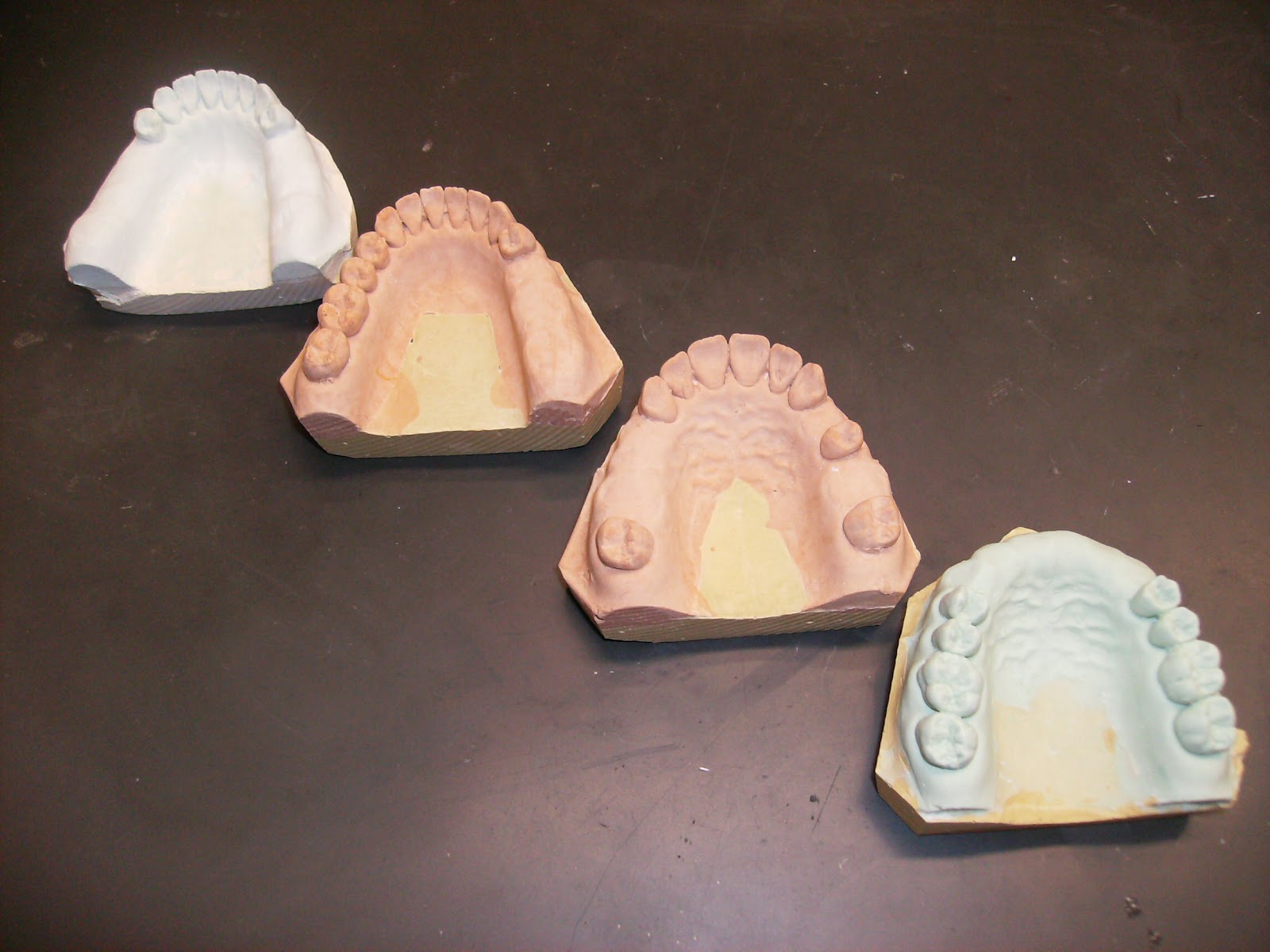 Protese Dentária: Protese Parcial Removível - PPR - Profº Fábio - 08/03 ...