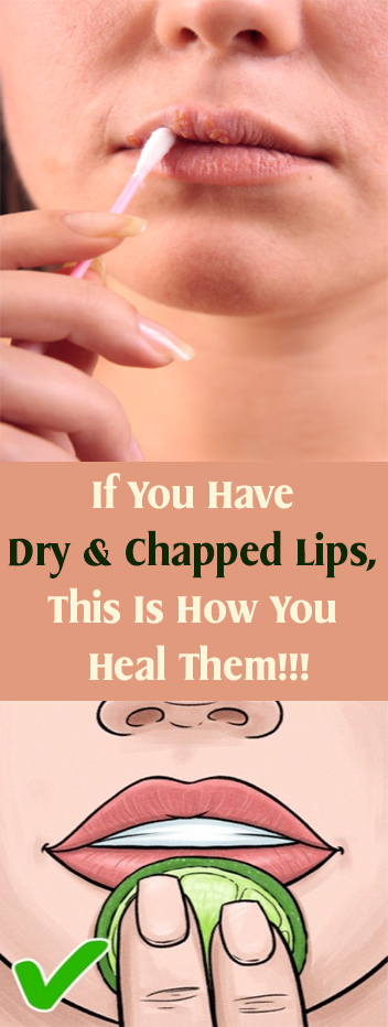 If You Have Dry & Chapped Lips, This Is How You Heal Them!!! - Daily ...
