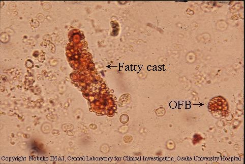 USMLE COMLEX Study Guides : Renal Pathology: Glomerular Diseases