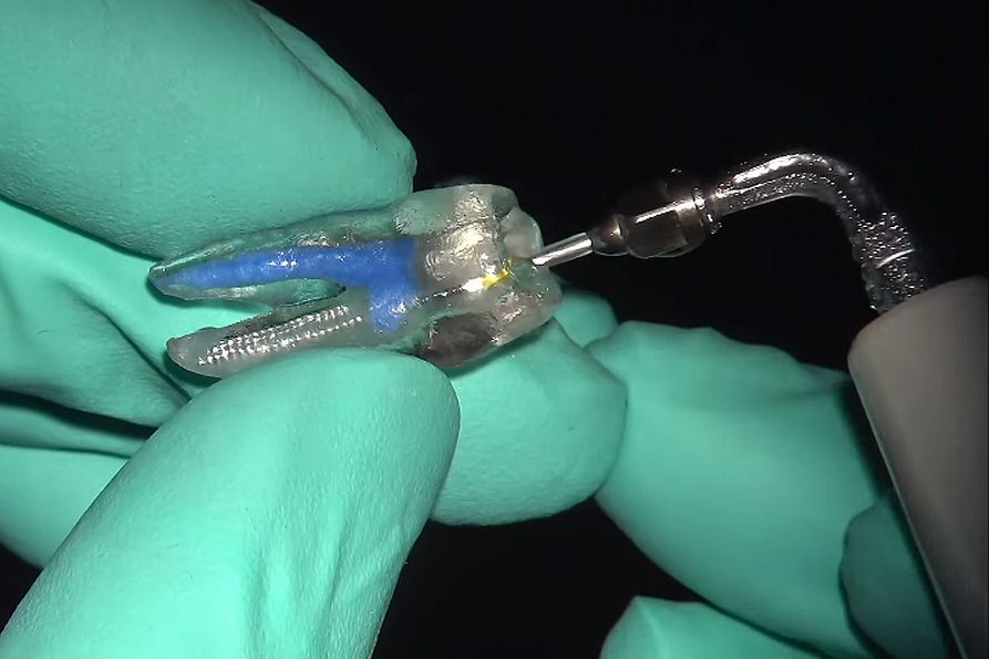 ENDODONTIC Passive Or Active Ultrasonic Activation Of Irrigation Dr endodontic-passive-or-active-ultrasonic-activation-of-irrigation-dr