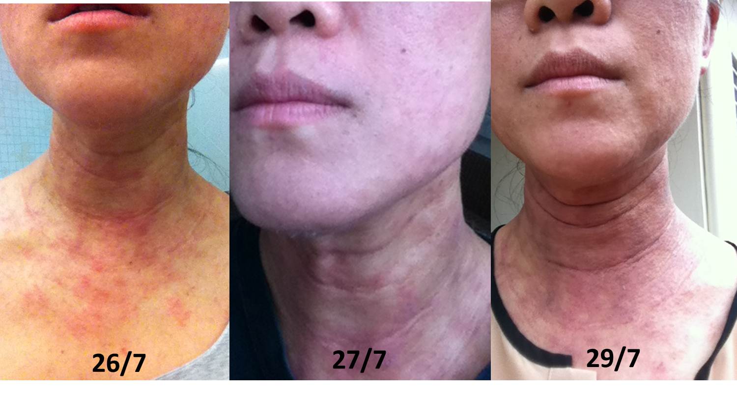 Marks of Life: Progression from the big flare (neck)