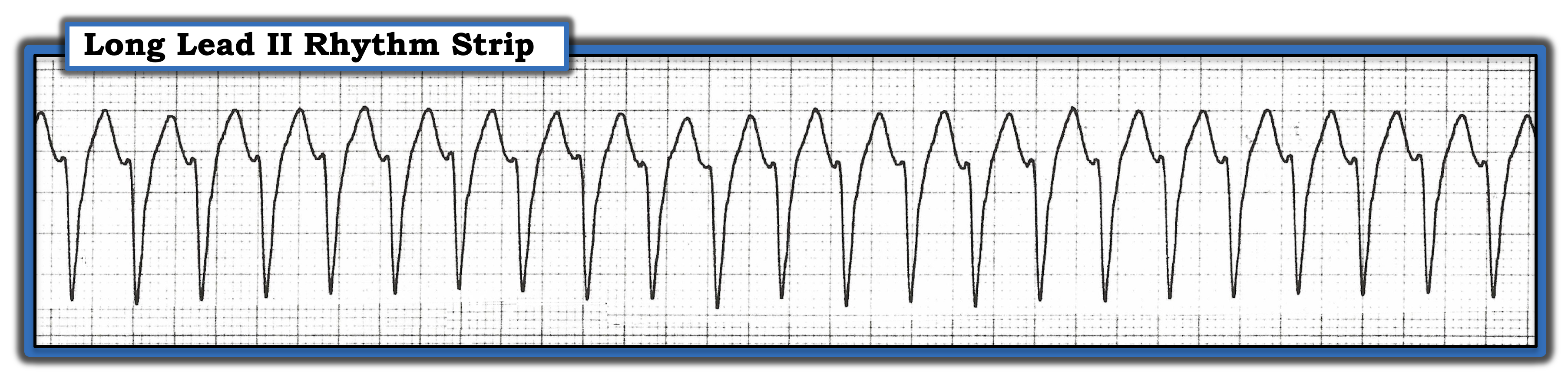 ECG Interpretation