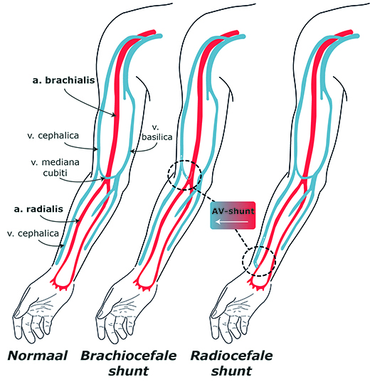 MEDICINE: Brescia-Cimino method (part 4)