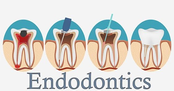 Secret to successful Endodontics procedure