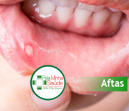 Pela Minha Saúde: Aftas... Podem ser evitadas e tratadas?