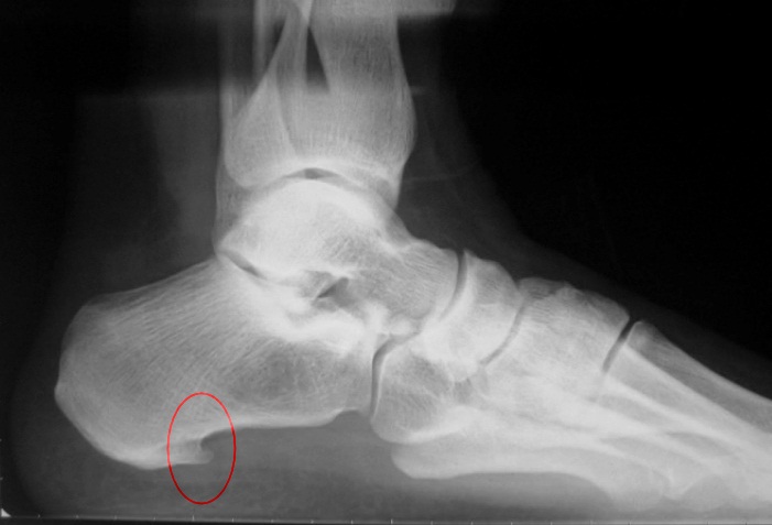 QUIROPRACTICO IGNACIO DÍAZ: FASCITIS PLANTAR, ESPOLÓN CALCÁNEO Y ...