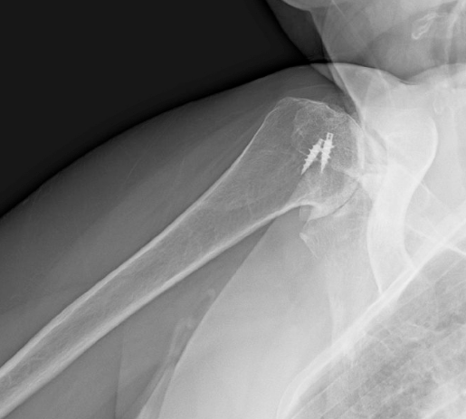 Shoulder and Elbow Surgery: Reverse shoulder replacement for cuff tear ...