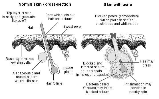 Acne (or Pimples): Causes, Risk Factors, Self-Help Advise and Treatment ...