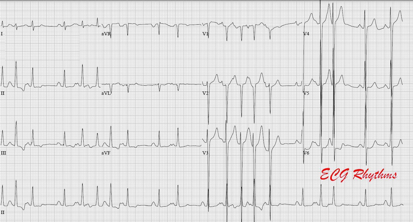 ECG Rhythms: WAP/MAR/MAT/Sinus arrhythmia