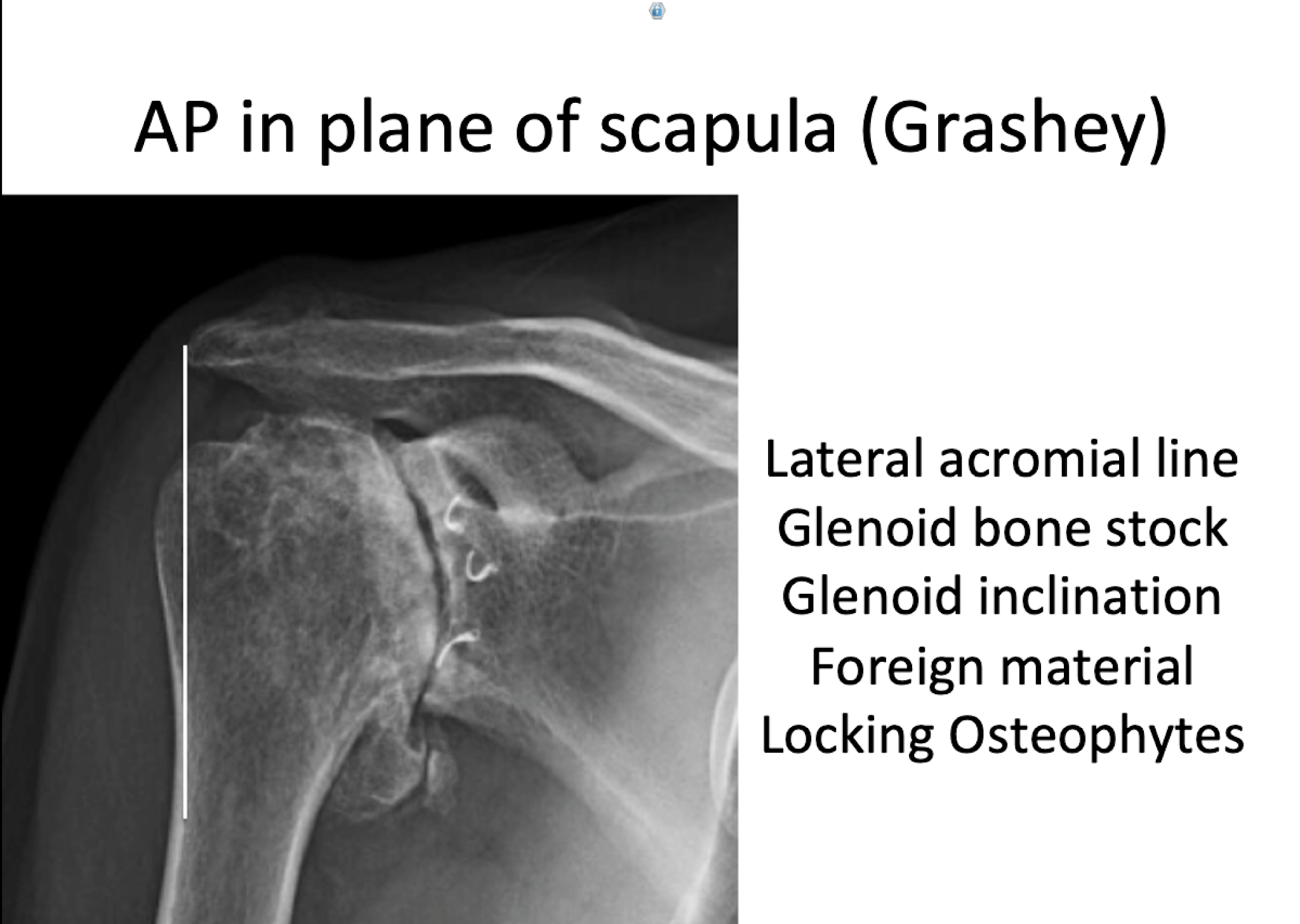 UW Shoulder and Elbow Academy: Ream and run - imaging the shoulder ...