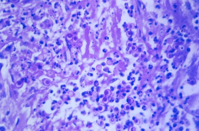 Blastomycosis-blastomycosis symptoms-blastomycosis treatment ...