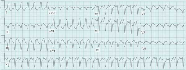 Wide Complex Tachycardia Case File