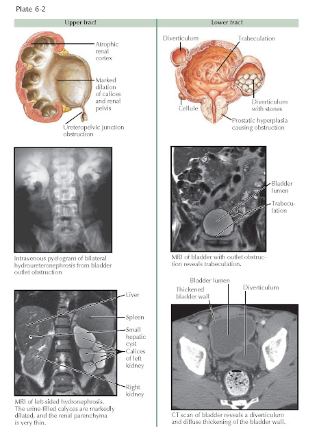 OBSTRUCTIVE UROPATHY - pediagenosis