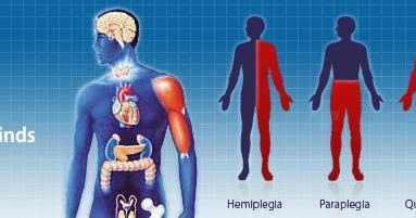 Treatment for Paralysis: Palamaner Paralysis Treatment