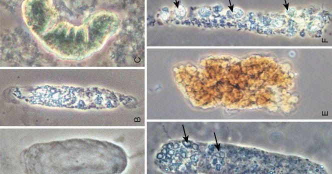 Medical Laboratory and Biomedical Science: Urinary casts