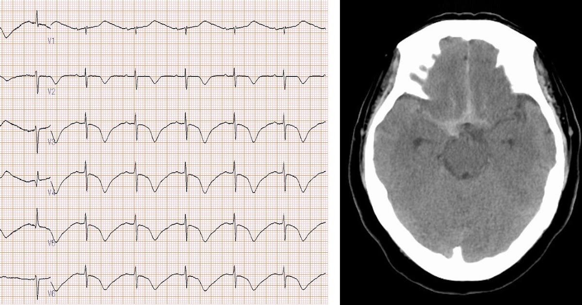 松下 ER ランチ・カンファレンス: ECG vs SAH