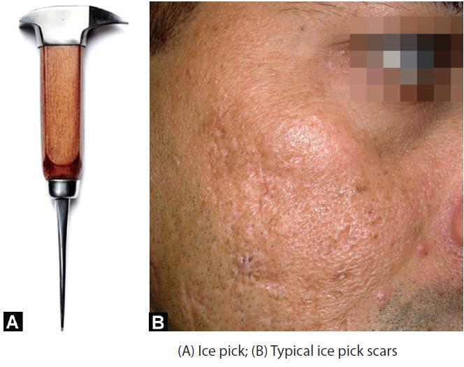Morphological Types of Acne Scars - Treatment of Acne Scars