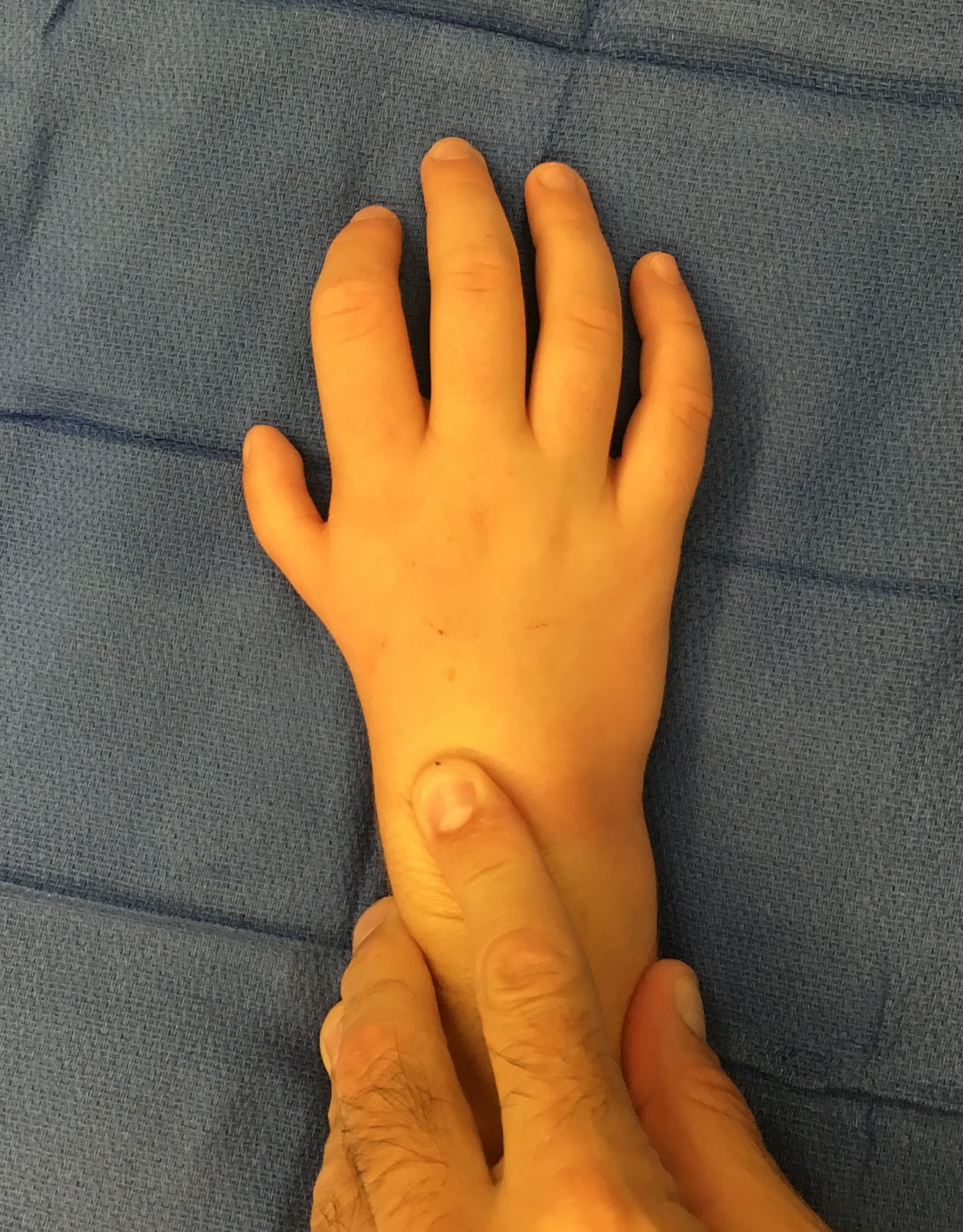 Patient Pollicization Testimonial | Congenital Hand and Arm Differences ...