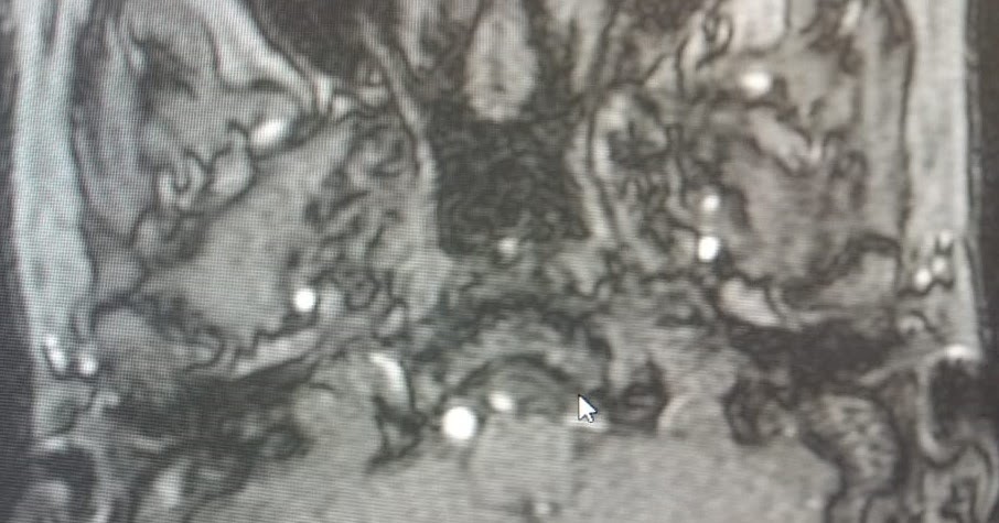 Bilateral ICA block: MRI - Sumer's Radiology Blog