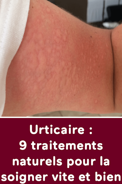 Remède pour l'urticaire chronique ~ Nos Conseils de Vie