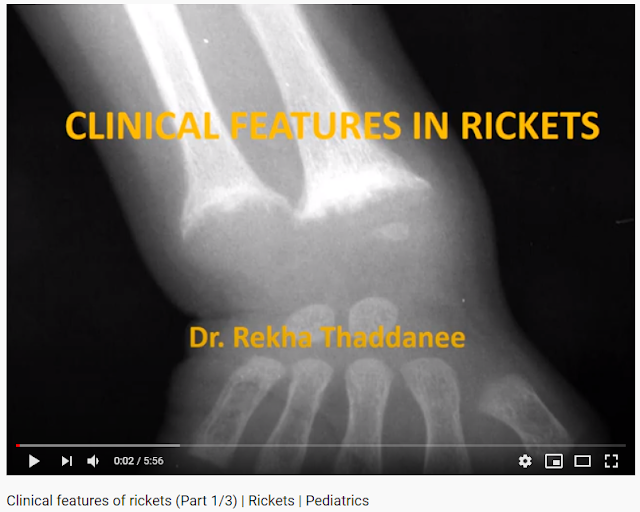 Video: Clinical features of rickets (Part 1/3) | Rickets | Pediatrics
