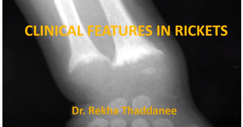 Video: Clinical features of rickets (Part 1/3) | Rickets | Pediatrics