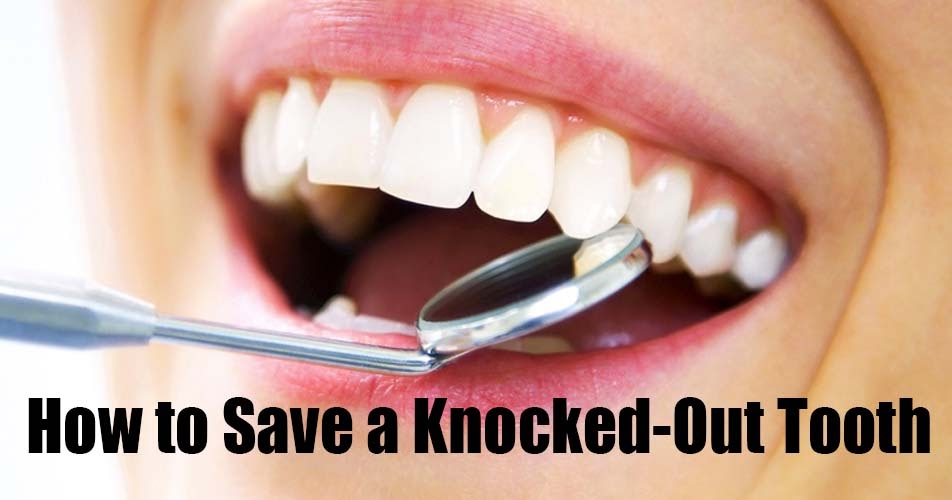 Treatment for Broken or Knocked-Out Teeth | Nurselk.com