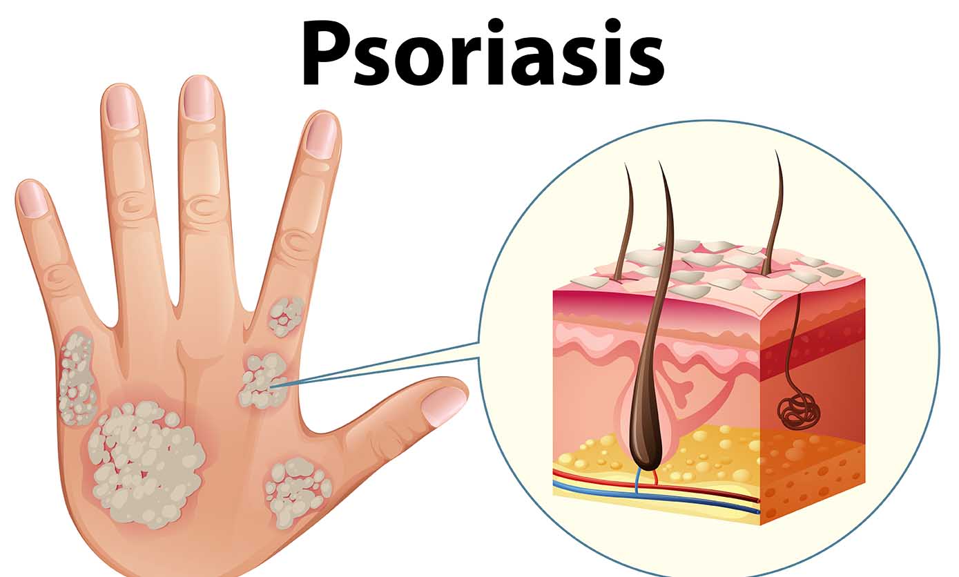 Psoriasis - Medical Yukti