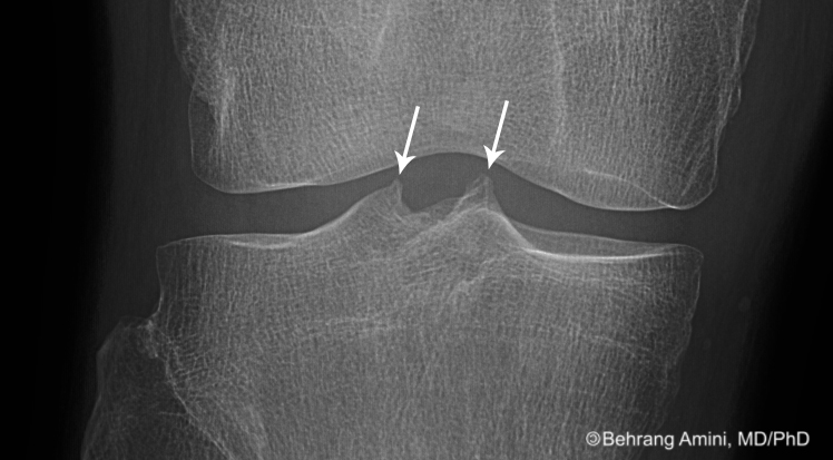 Roentgen Ray Reader: Intercondylar Spine Spiking and Osteoarthritis