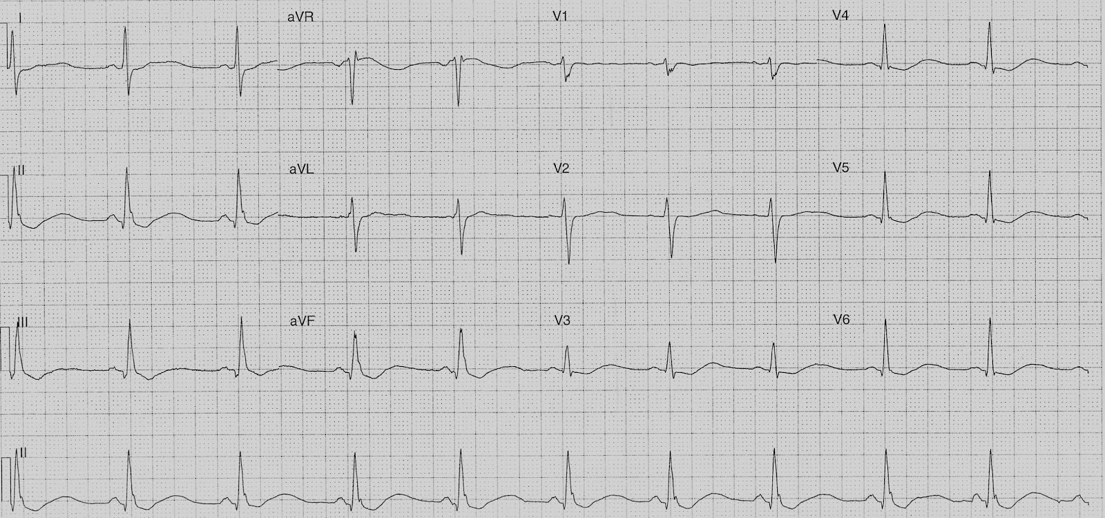 ECG of the Week: ECG of the Week - 10th February 2014