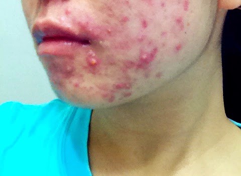 Colour my sun.: Acne Horror