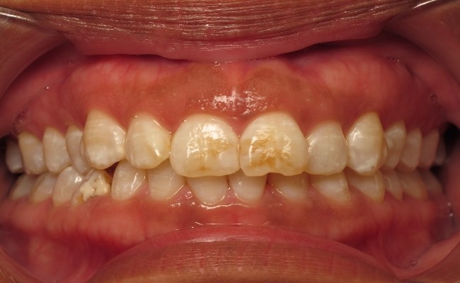 Extrinsic Teeth Stains