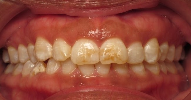 Extrinsic Teeth Stains