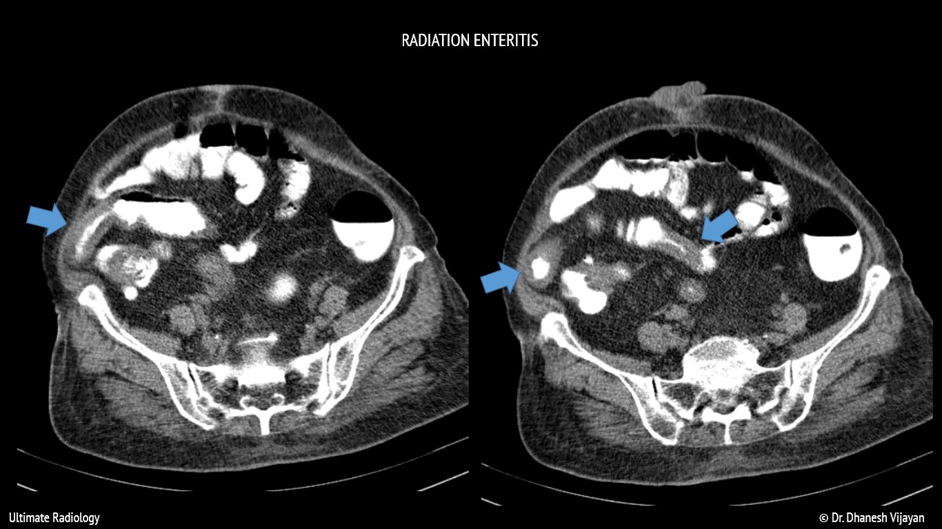 Ultimate Radiology : Radiation enteritis